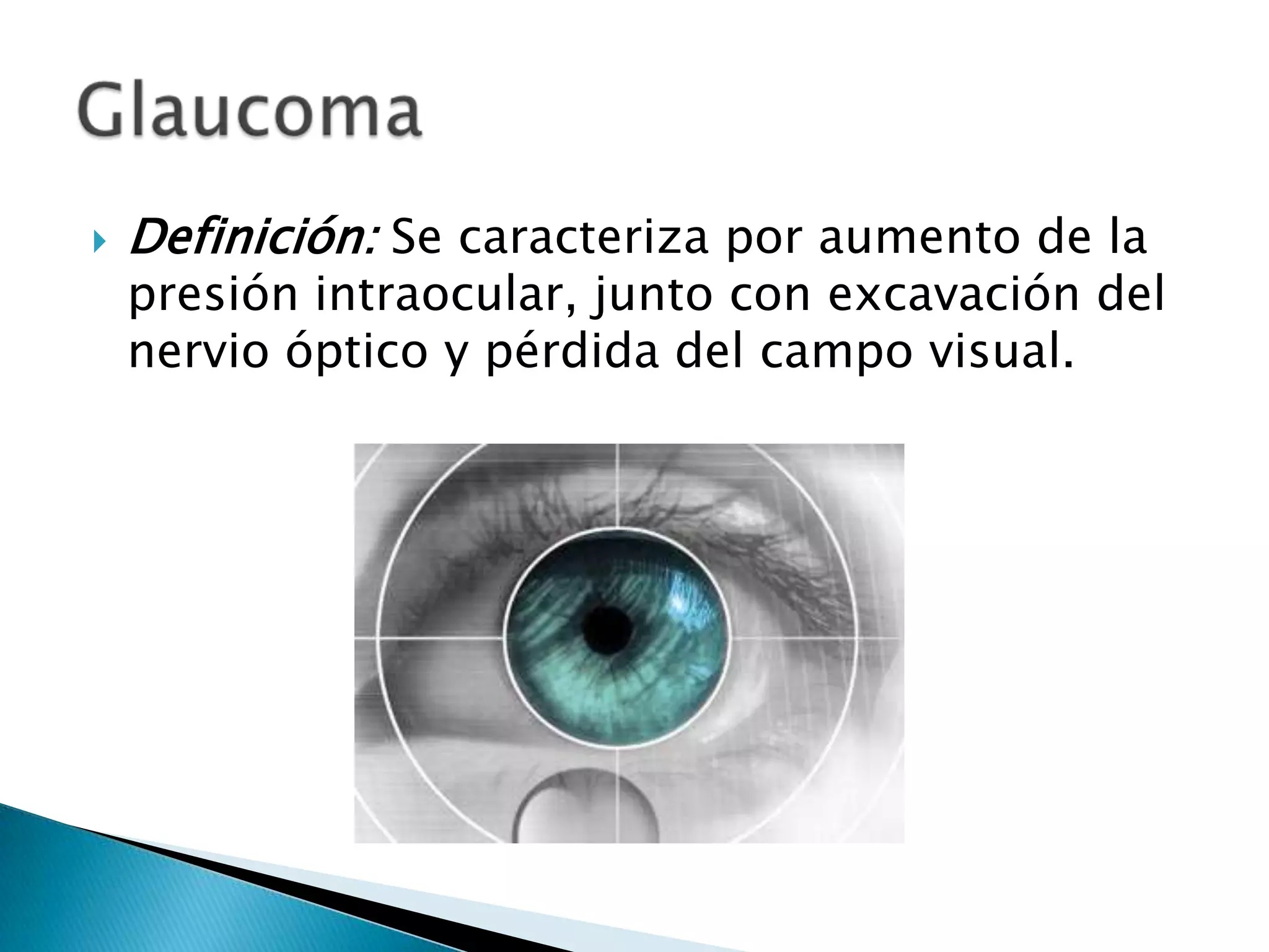Glaucoma de ángulo abierto primario y secundario | PPTX | Eye and ...