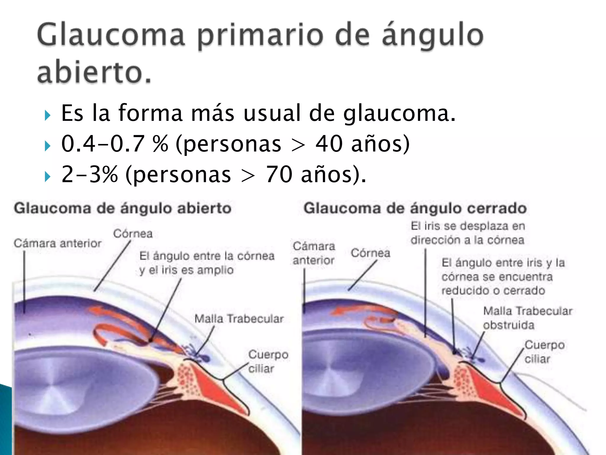 Glaucoma de ángulo abierto primario y secundario | PPTX | Eye and ...