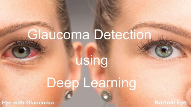Glaucoma Detection using Deep Learning.pptx