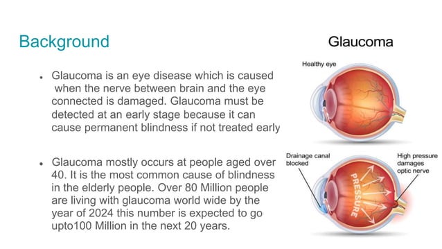 Glaucoma Detection using Deep Learning (1).pptx
