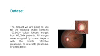 Glaucoma Detection using Deep Learning (1).pptx