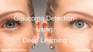 Glaucoma Detection using Deep Learning (1).pptx
