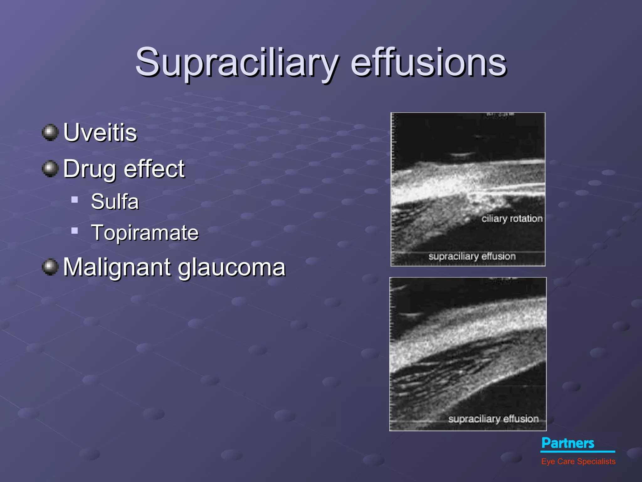 Glaucoma dr.gosiengfiao dr.pangalanan | PPT