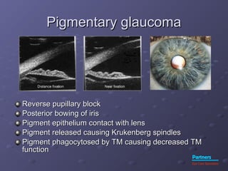 Glaucoma dr.gosiengfiao dr.pangalanan | PPT