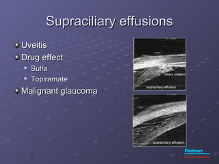 Glaucoma dr.gosiengfiao dr.pangalanan | PPT