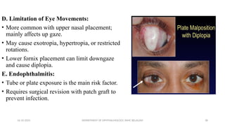 glaucoma drainage device its pros and cons meachnisiom of action and ...