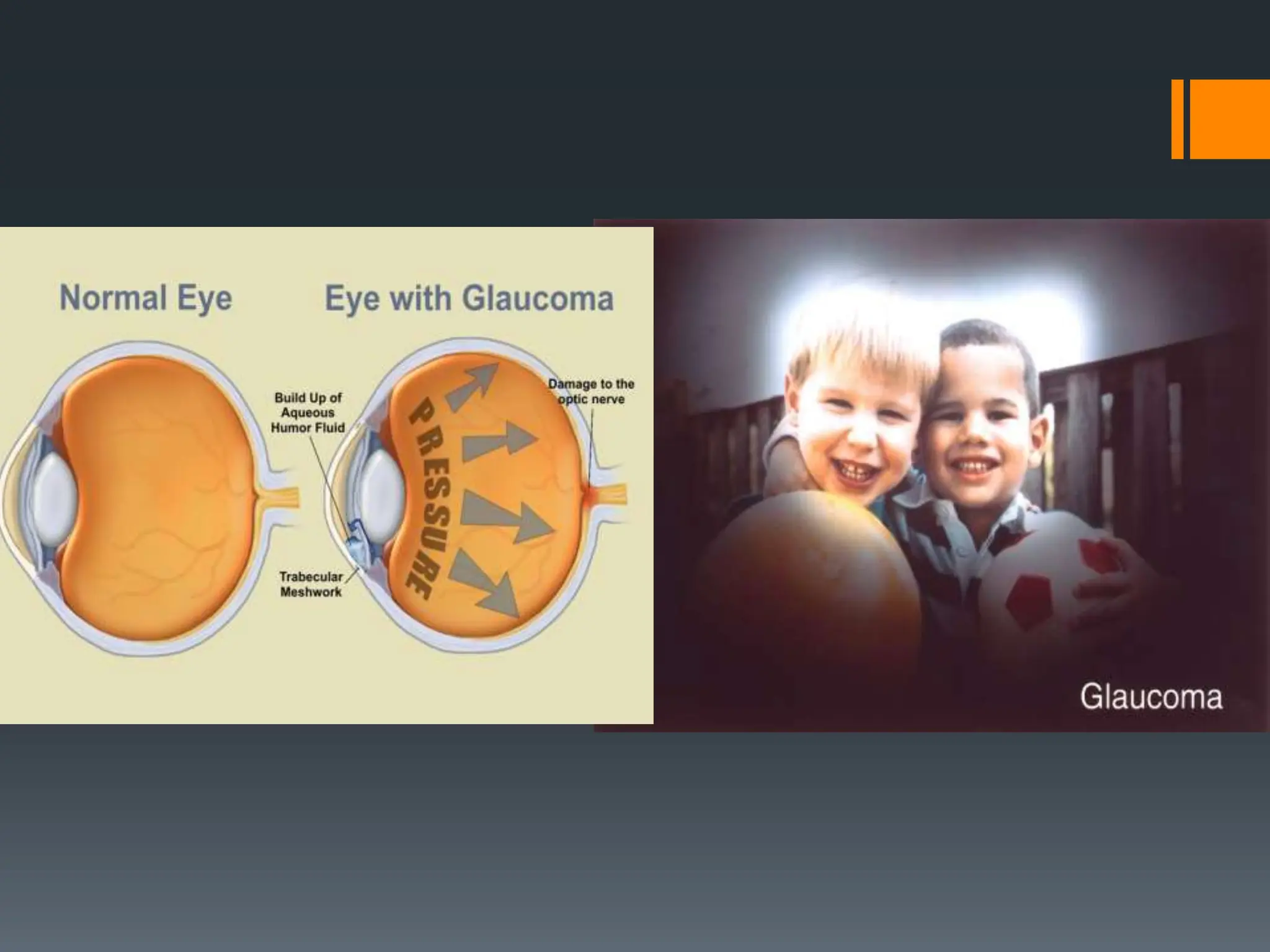 Pharmacology of glaucoma slideshare.pptx. | PPTX | Eye and Vision ...