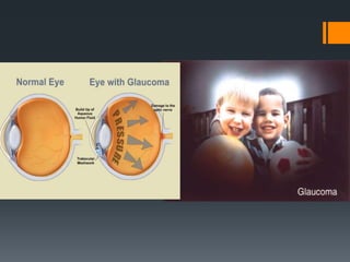Pharmacology of glaucoma slideshare.pptx. | PPT
