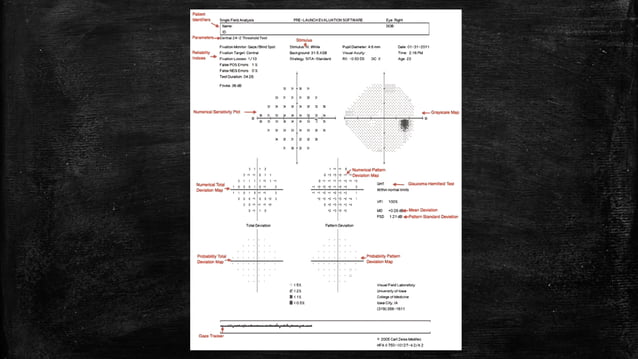 The Complete Approach To Glaucoma Evaluation | PPT