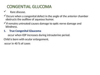 glaucoma Final PowerPoint done my Malama | PPTX