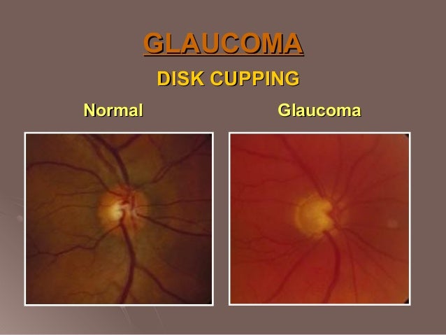 Glaucoma good