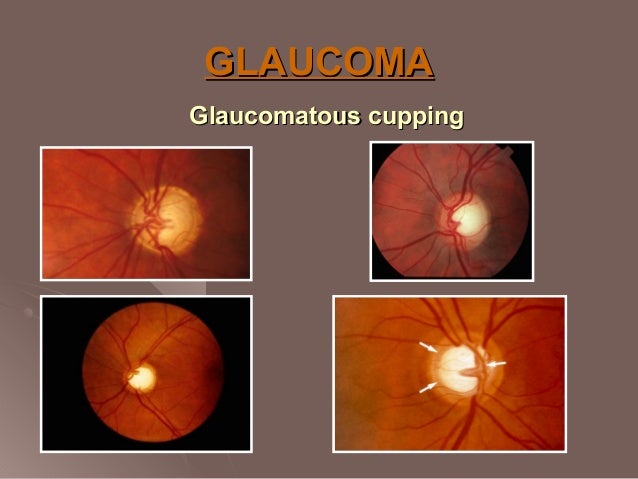 Glaucoma good