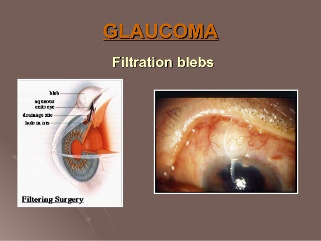 Glaucoma good