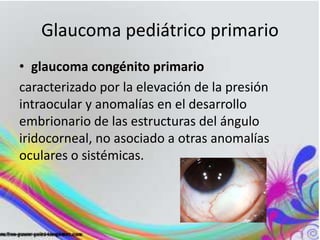 Glaucoma infantil 2016 (1) | PPTX