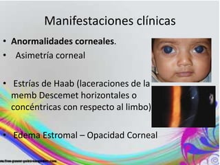 Glaucoma infantil 2016 (1) | PPTX
