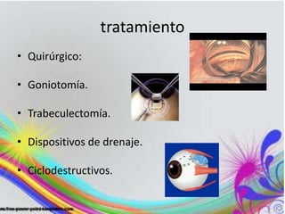 Glaucoma infantil 2016 (1) | PPTX