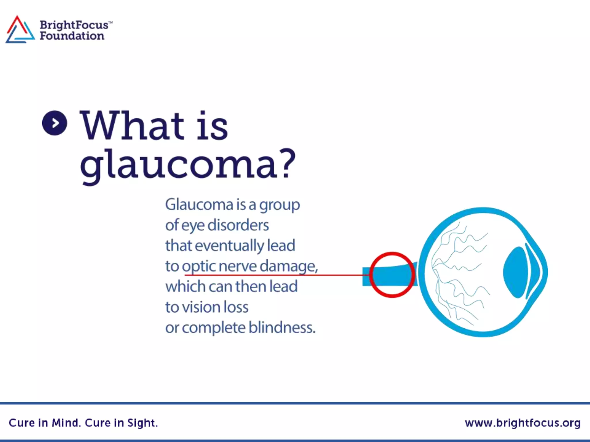 Save Your Sight From Glaucoma | PPT