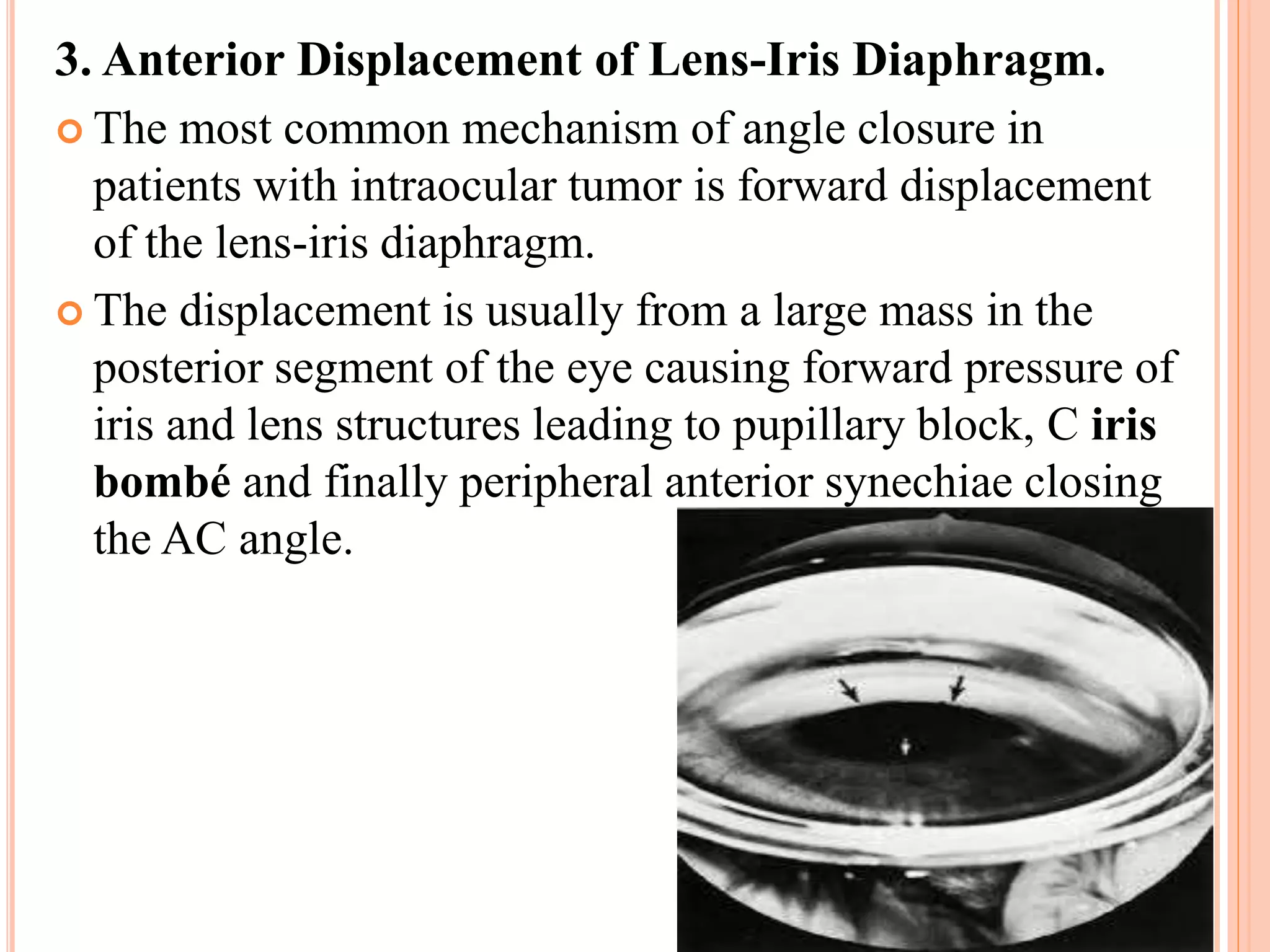 Glaucoma In Intra Ocular Tumour | PPTX