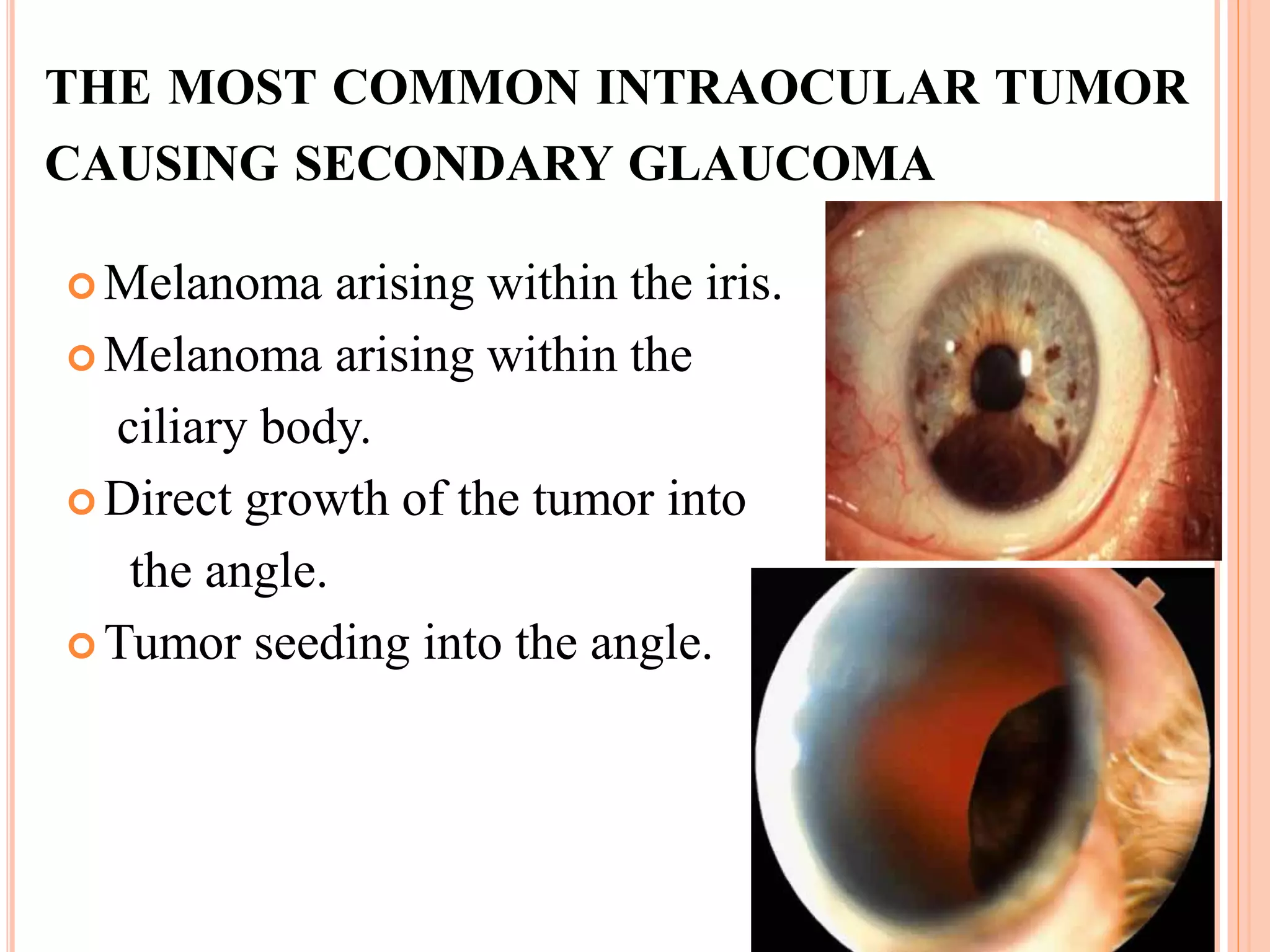 Glaucoma In Intra Ocular Tumour | PPTX