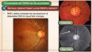 Glaucoma intro | PPTX