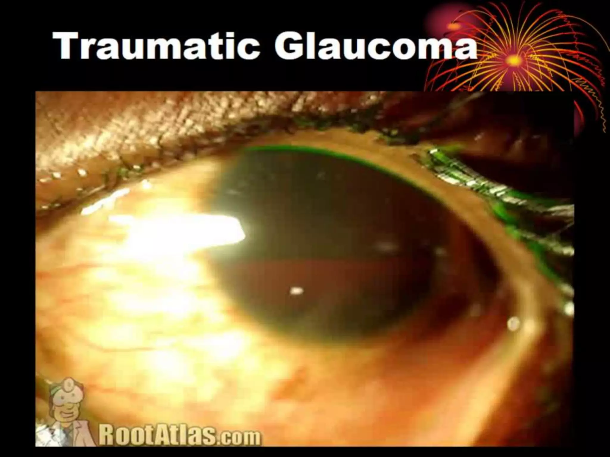 Glaucoma lecture pict by dr abdul basir safi | PPT