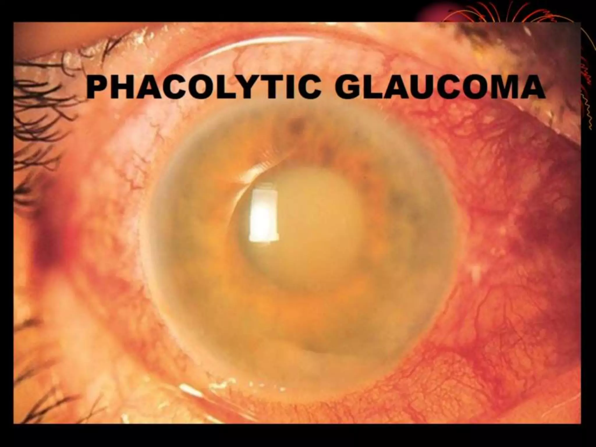 Glaucoma lecture pict by dr abdul basir safi | PPT