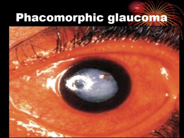 Glaucoma lecture pict by dr abdul basir safi | PPTX