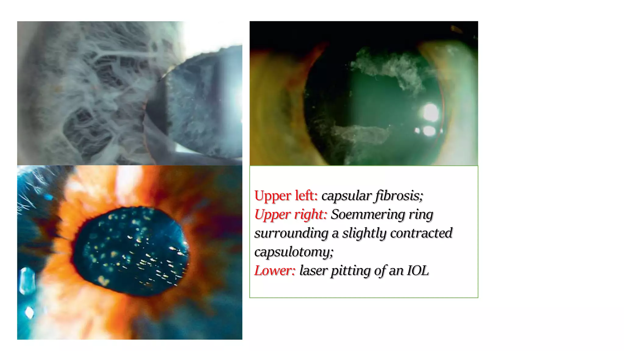 Glaucoma & lens | PPTX