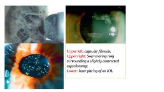 Glaucoma & lens | PPTX