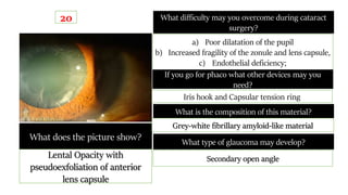 Glaucoma & lens | PPTX