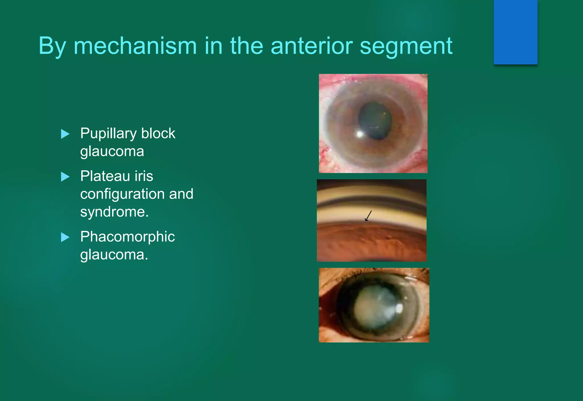 Glaucoma management paradigms | PPTX