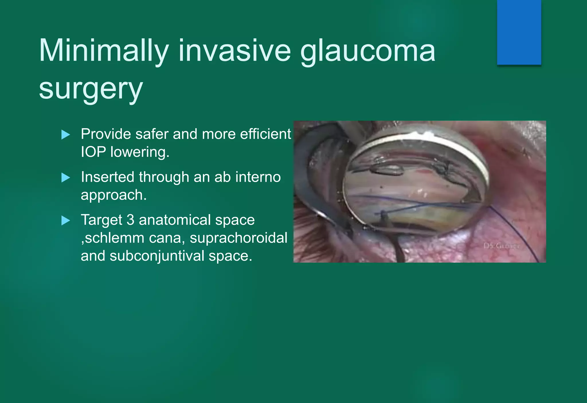 Glaucoma management paradigms | PPTX