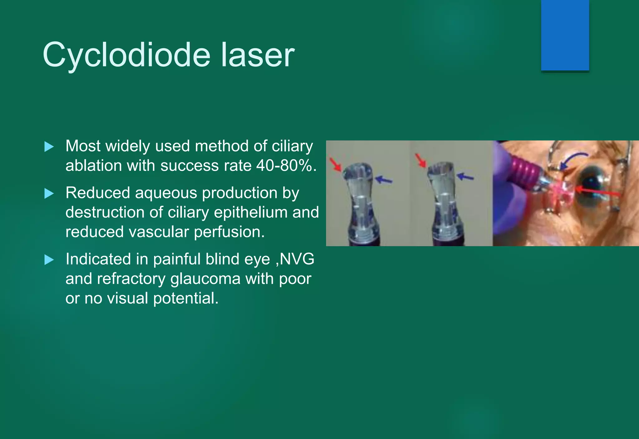 Glaucoma management paradigms | PPTX