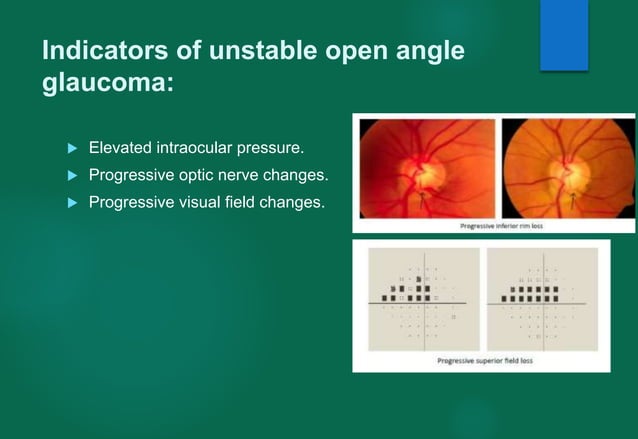 Glaucoma management paradigms | PPTX | Eye and Vision Conditions | Diseases and Conditions