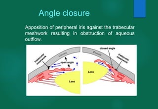Glaucoma management paradigms | PPTX
