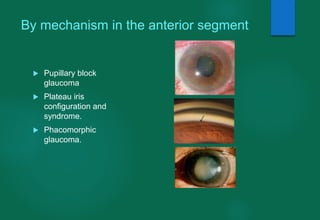 Glaucoma management paradigms | PPTX