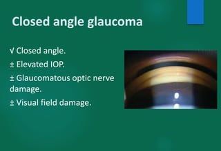 Glaucoma management paradigms | PPTX