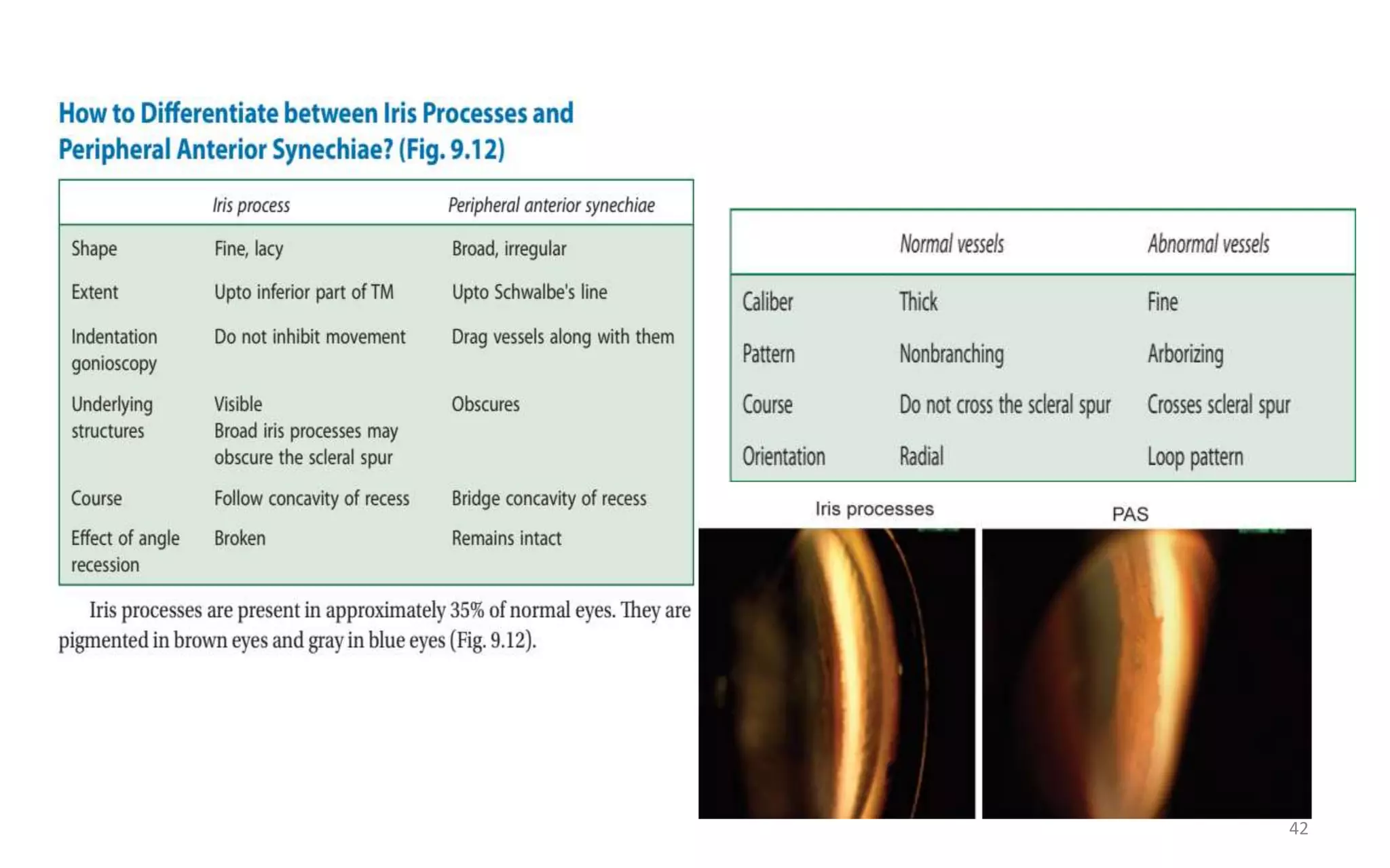 glaucoma modified.pptx