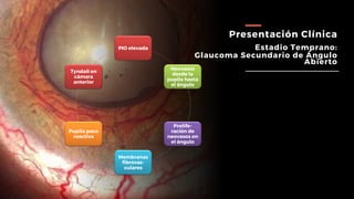 Glaucoma Neovascular | PPTX