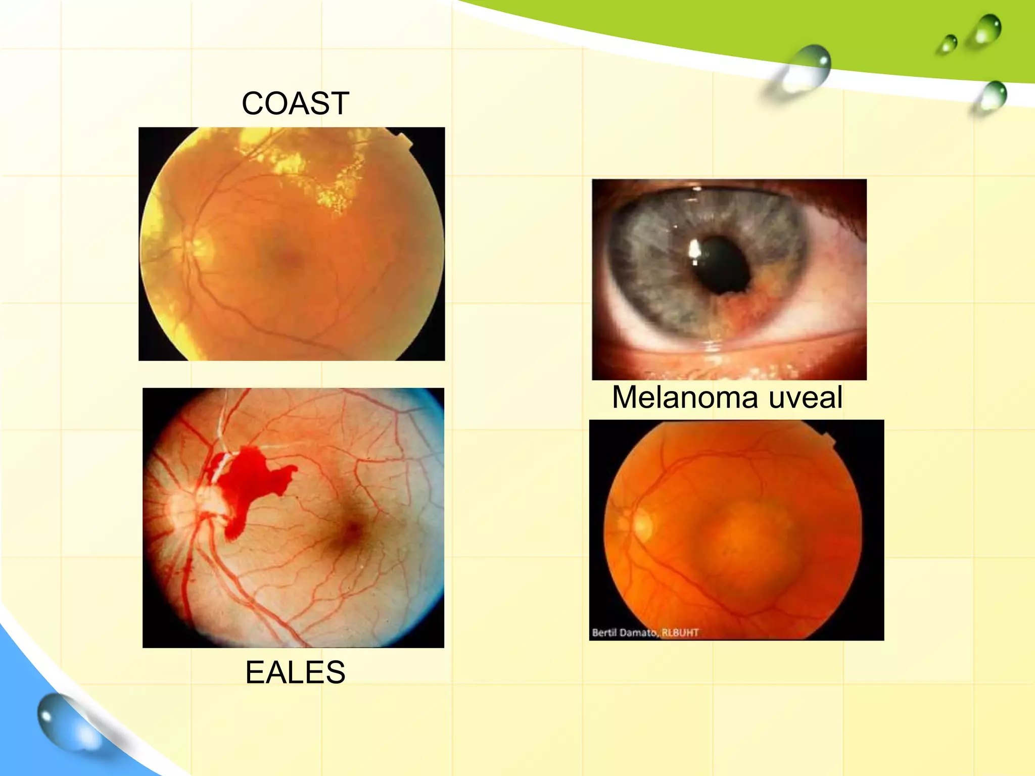 Glaucoma neovascular lml | PPTX