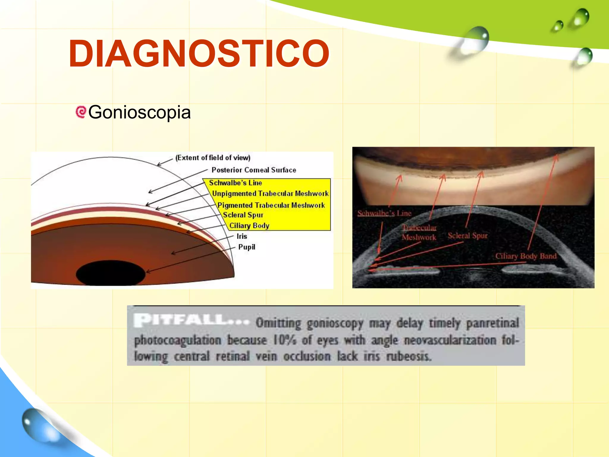 Glaucoma neovascular lml | PPTX