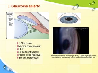 Glaucoma neovascular lml | PPTX
