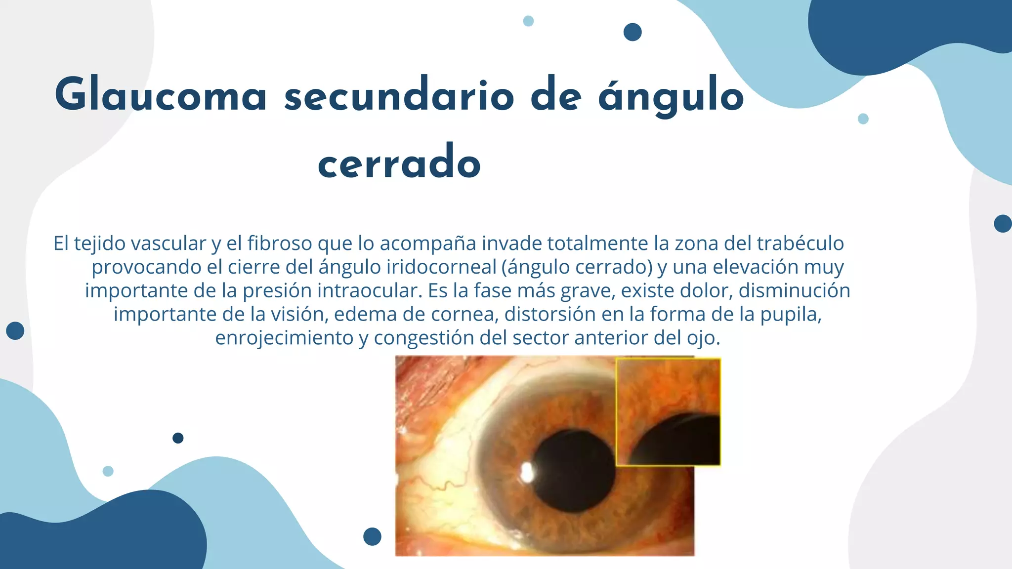 GLAUCOMA_NEOVASCULAR_UCB.pptx