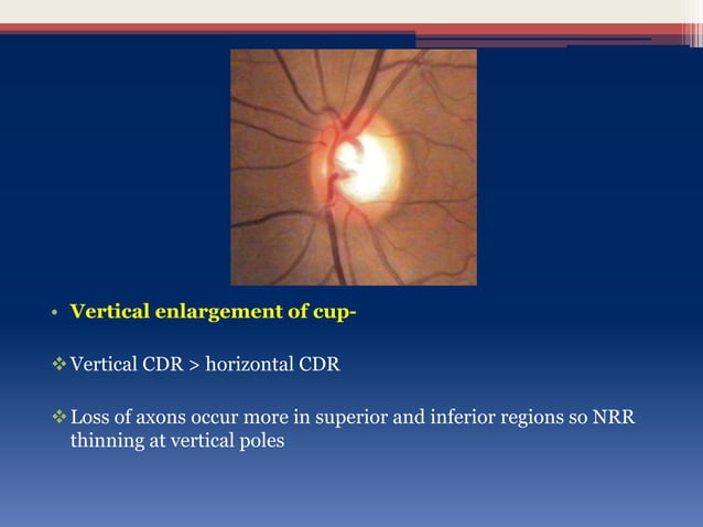 Glaucoma optic disc changes | PPTX | Eye and Vision Conditions ...