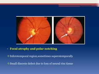 Glaucoma optic disc changes | PPTX