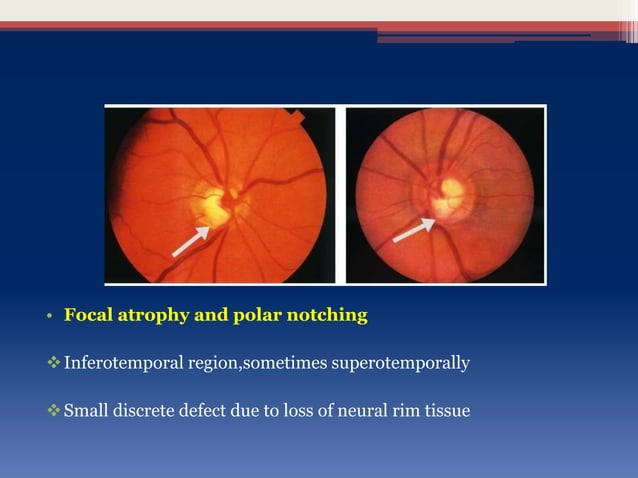 Glaucoma optic disc changes | PPTX | Eye and Vision Conditions ...
