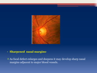 Glaucoma optic disc changes | PPTX