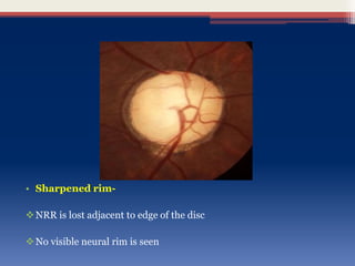 Glaucoma optic disc changes | PPTX