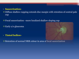 Glaucoma optic disc changes | PPTX