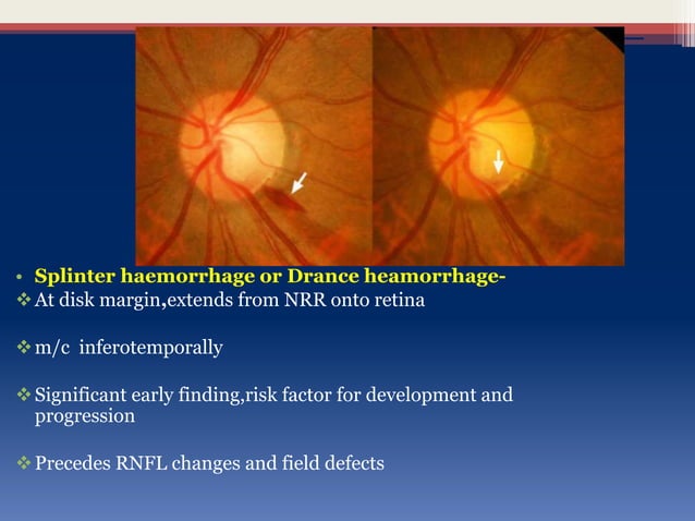 Glaucoma optic disc changes | PPTX | Eye and Vision Conditions | Diseases and Conditions